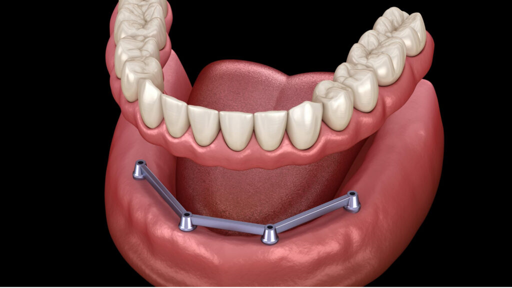 All on 4 Dental Implants Procedure Concept | Regain Teeth